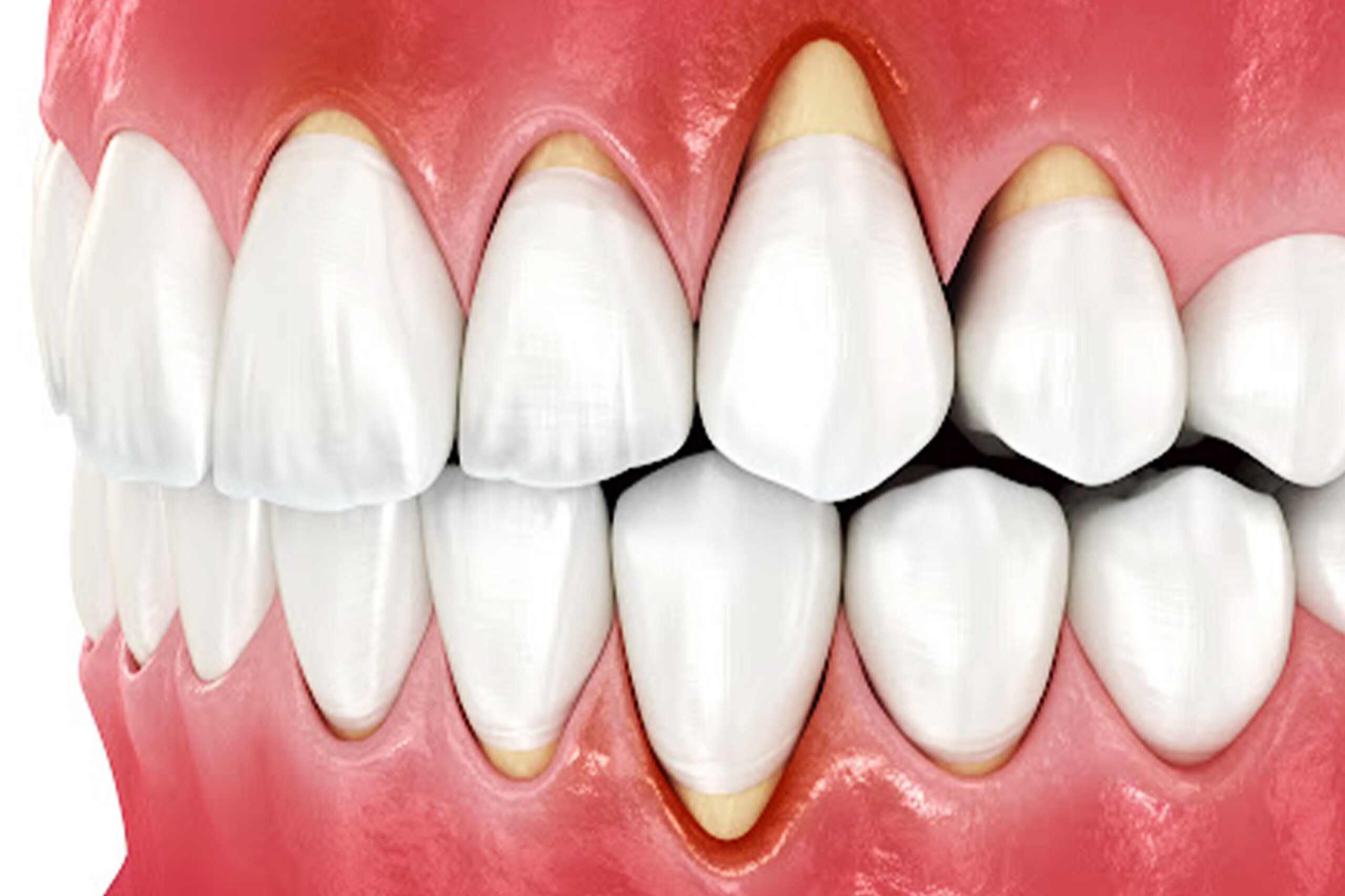 The Top Causes of Gum Recession and How to Prevent It