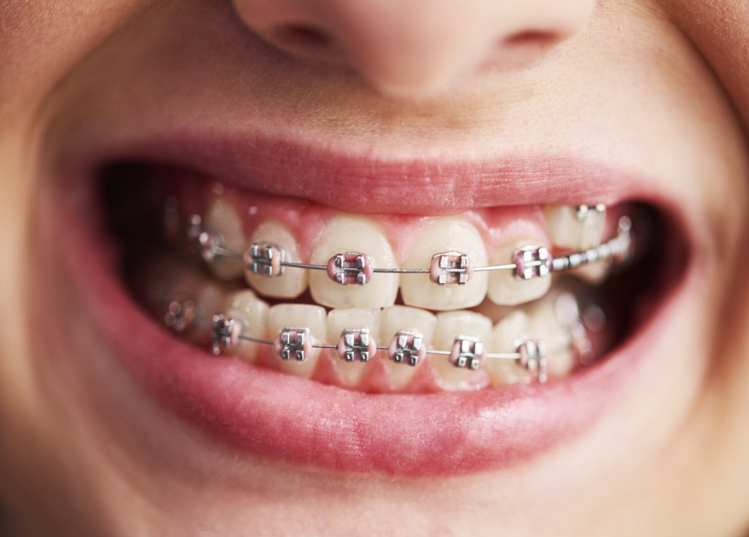 Best Dentist for Braces - Straighten Your Smile with Confidence