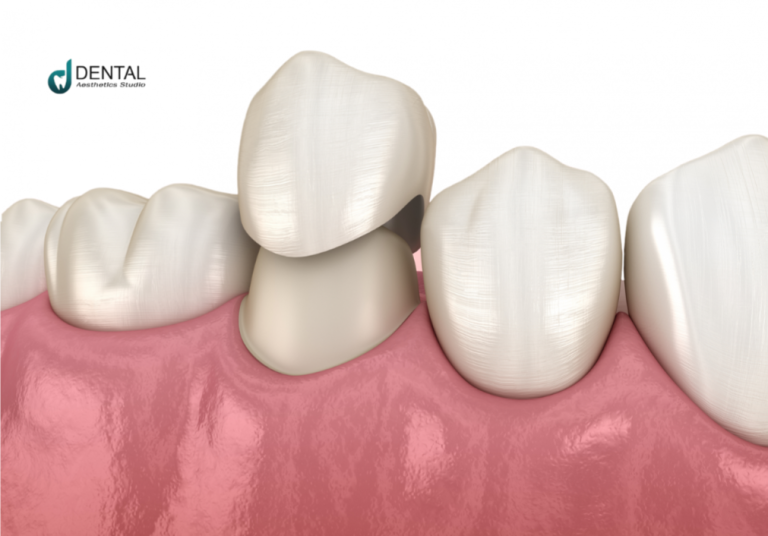 Are Dental Crowns Permanent?