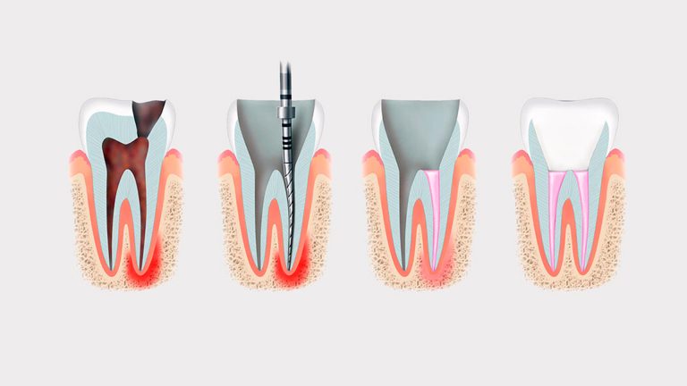 How To Reduce Root Canal Pain?