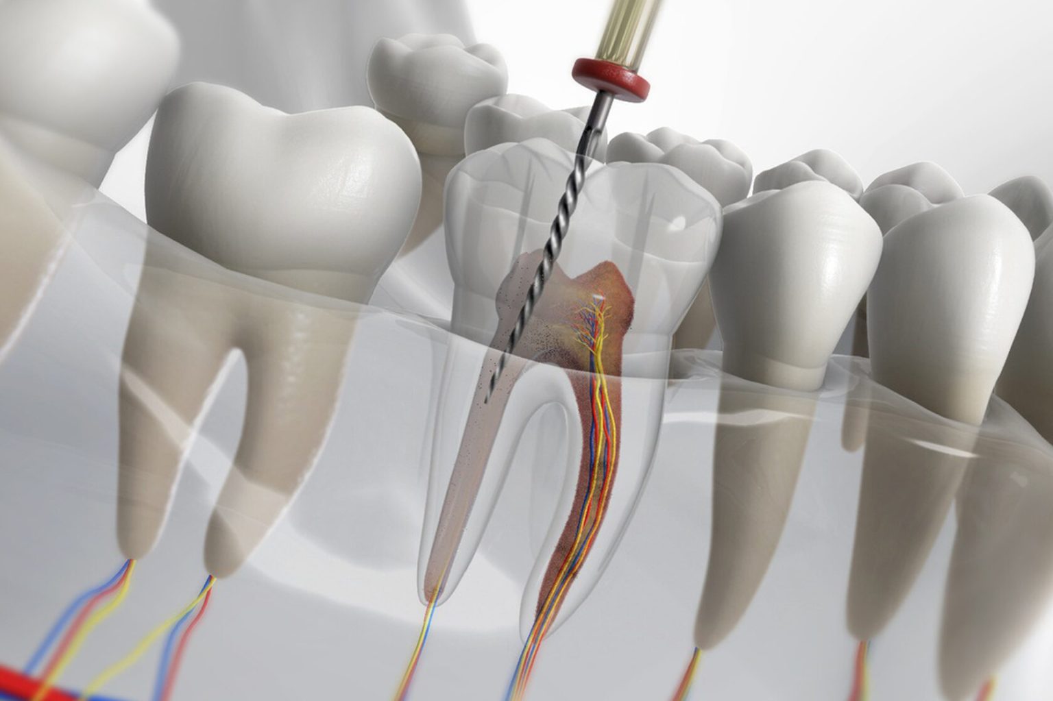 Can I just get a filling instead of a crown after a root canal?